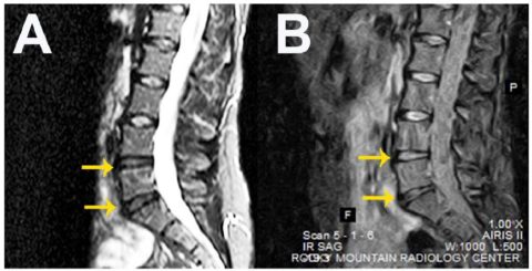 Regenexx Stem Cells for Back Pain in Bellevue and Seattle